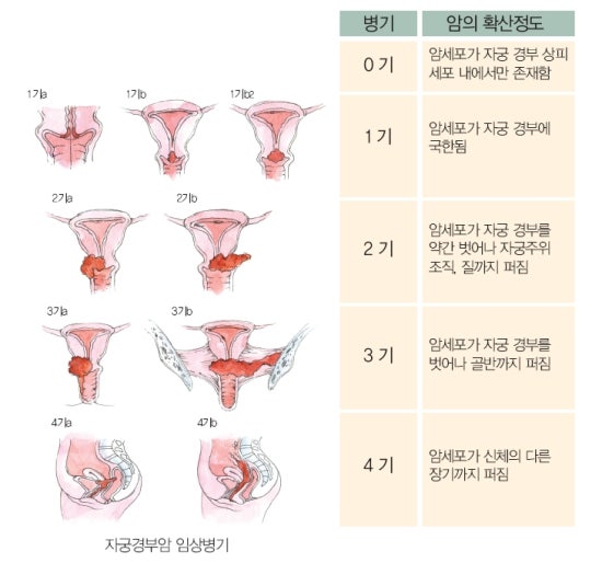 자궁경부암의 임상 병기 네이버 블로그