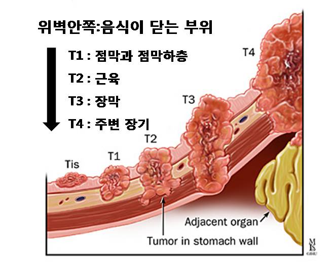 조기위암 진행위암 위암병기 네이버 블로그