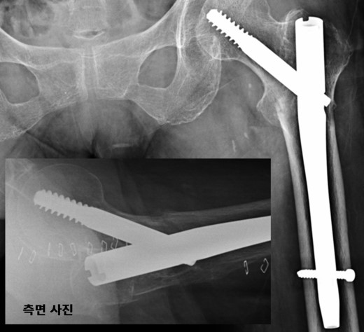 보상마스터 교통사고후유장애진단서 대퇴골 비구부골절 장해 보상 대퇴골골절 교통사고합의금 계산법 네이버 블로그