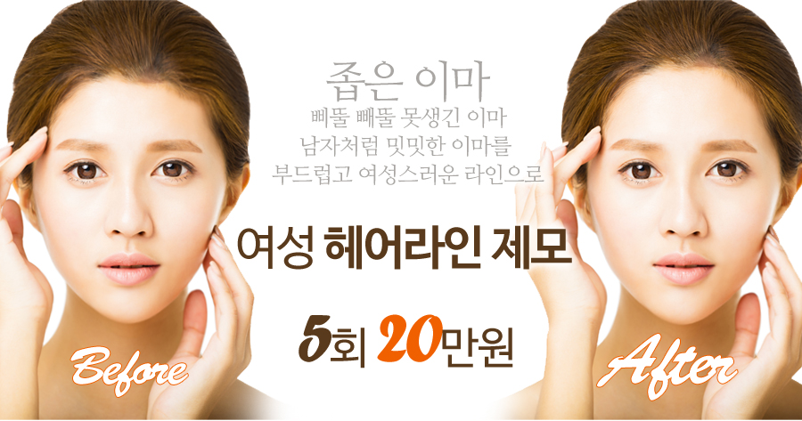 여성 헤어라인 제모 And 뒷목 제모 네이버 블로그