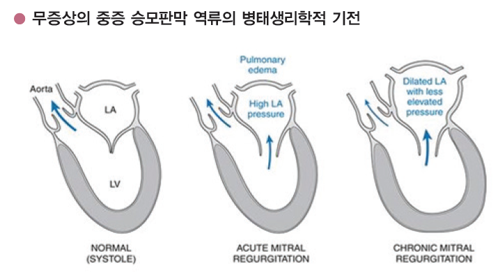 Asymptomatic Severe Mr How To Manage 무증상 중증 승모판막 역류의 치료 네이버 블로그