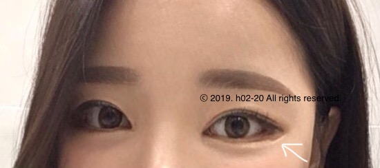 자연스러운 눈밑 애교필러 애교살필러 후기 전후사진o 네이버 블로그