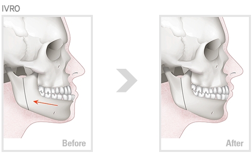 양악수술 - 하악수술방법인 IVRO 법과 SSRO 법 : 네이버 블로그