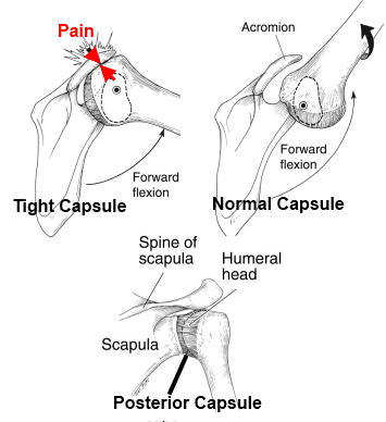 [한국인재교육원] 상완골 전방 활주 증후군 Humeral anterior glide syndrome 2_ 검사, 평가, 관리 ...