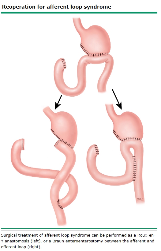 Afferent and efferent loop syndrome : 네이버 블로그