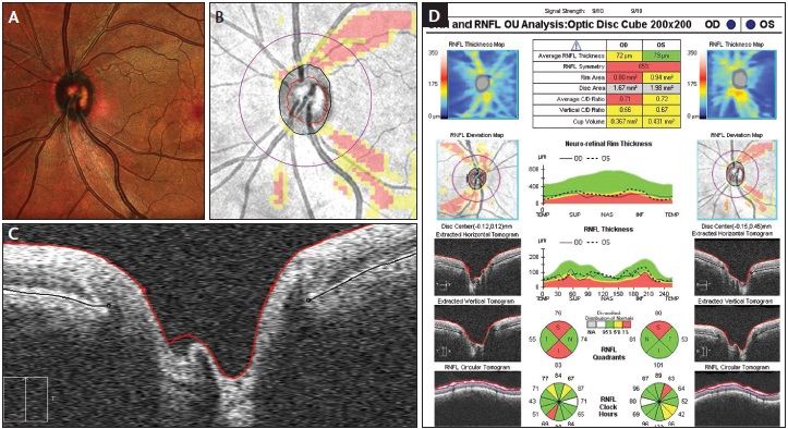 Tilted Optic Disc