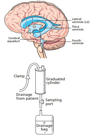 EVD[External Ventricular Drainage] : 뇌실 외 배액. 간호. : 네이버 블로그