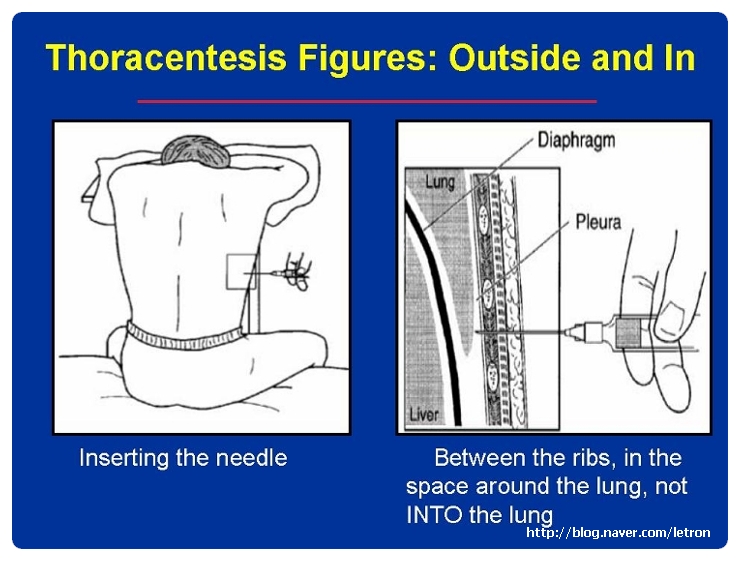 Thoracentesis : 네이버 블로그